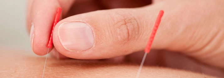 How Dry Needling Therapy Can Treat Migraines and Headaches